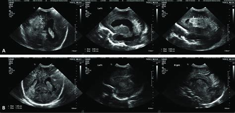 A Brain Ultrasonography Of The First Infant The Left Middle And Download Scientific