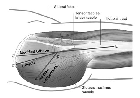 Safe Surgical Dislocation Of Hip Epomedicine