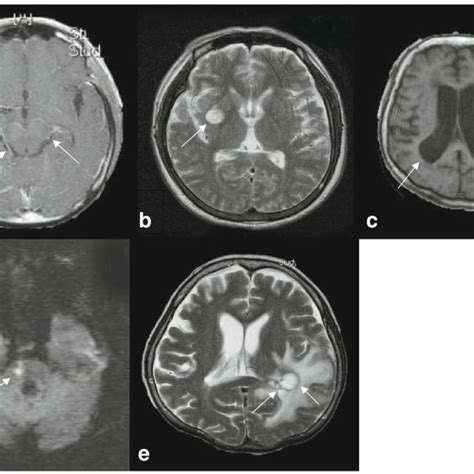 The Prognostic Factors Of The 38 Elderly Patients With Cryptococcal Download Table
