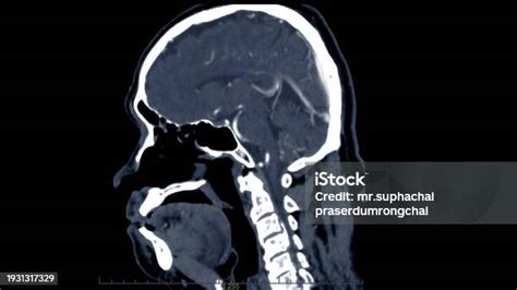 Ct Scan Of The Brain Sagittal View For Diagnosis Brain Tumor Stroke