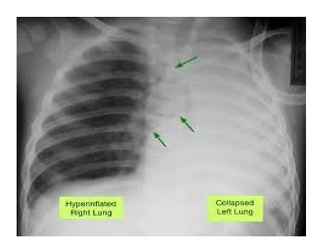 Collapse And Consolidation Lung Radiology Ppt