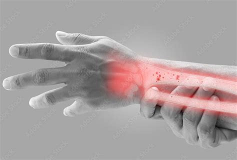 Osteogenesis Imperfecta Causes Symptoms And Prevention Tips