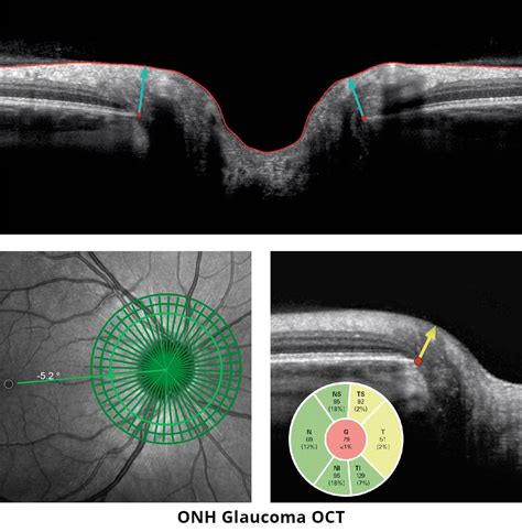 Glaucoma Ashu Laser Vision