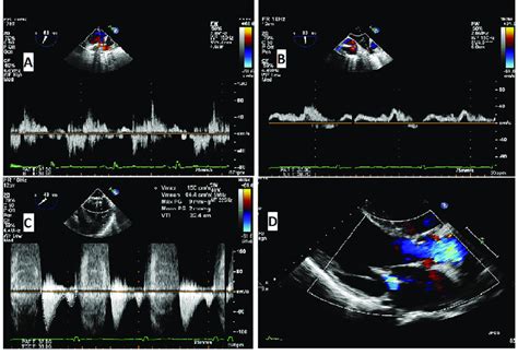 Pulmonary Flow Reversal Echo At Dominick Whipple Blog