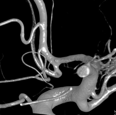 Anterior Cerebral Artery