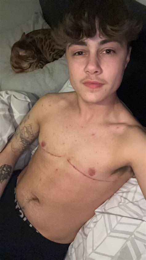 6 Weeks Post Op Double Incision W Free Nipple Grafts Dr Ergin