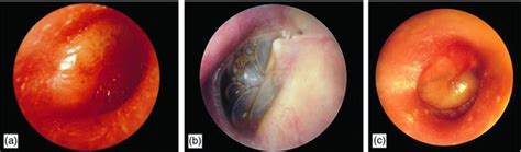 Normal Tympanic Membrane Vs Bulging