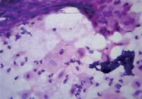 Squamous Cells Isolated And In Sheets H And E X100 Download