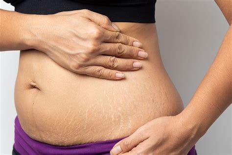 Stretchmarks In Pregnancy Madeformums