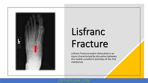 What Is Lisfranc Fracture Orthofixar Orthopedic Surgery Posted On