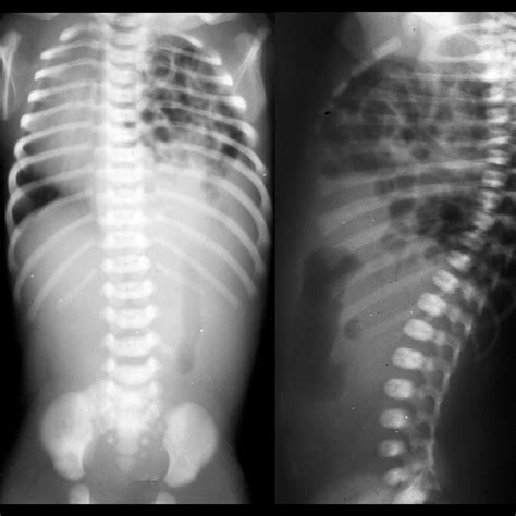 Congenital Diaphragmatic Hernia Mri Congenital Diaphragmatic Hernia