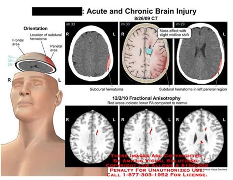 Amicus Illustration Of Amicusinjurybrainacutechronicfrontalarea