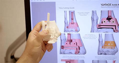 Patient Specific Ankle Replacement Helps Restore Mobility For Florida Resident 3d Systems