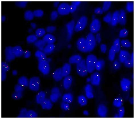 Usp6 Break Apart Fluorescence In Situ Hybridization Download