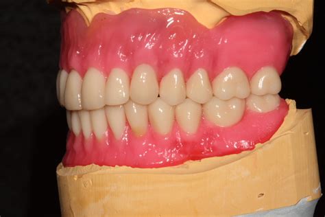 Upperandlower Dentures Hader Bar Ball Attachment Dr Costin Marinescu Disa Journal Disa Dental