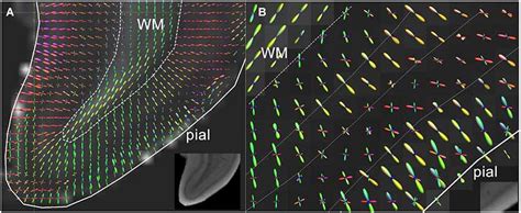 A High Resolution Diffusion MRI Of Sub Cortical White Matter And Download Scientific Diagram