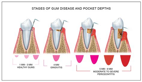 Gum Disease Stages