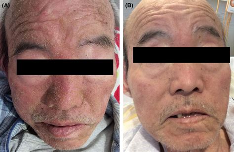 Zinc Deficiency Acrodermatitis Enteropathica Nutritional Pathology