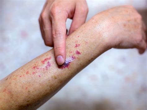 Purpuric Rash Causes Pictures And When To Get Medical Help