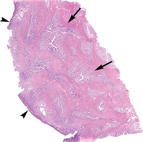 Mr Imaging Findings Of Adenomyosis Correlation With Histopathologic