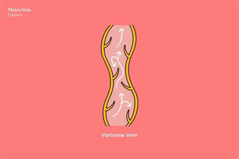 Pregnancy And Varicose Veins