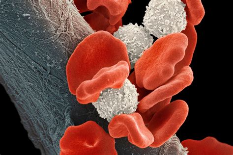 Multiple Myeloma Treatment Breakthroughs And Future Innovations