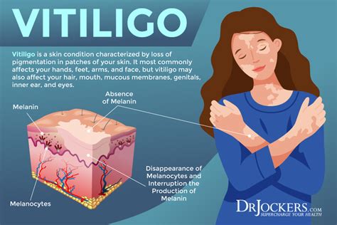 Vitiligo Symptoms Causes And Support Strategies