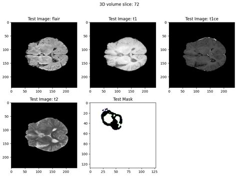 Github Theodoremanuelsson3d Braintumor Segmentation 3d Unet Model