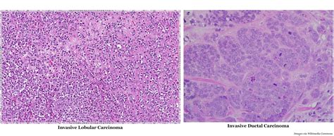 Invasive Lobular Carcinoma Invasive Lobular Carcinoma Mimicking