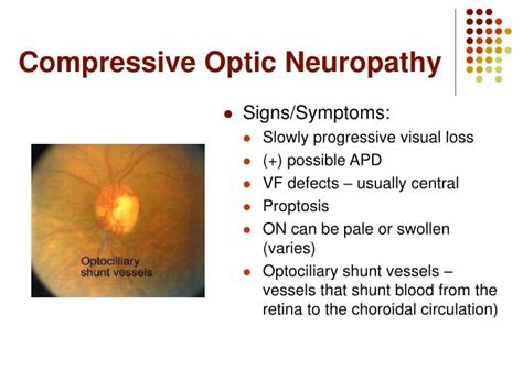 Ppt Optic Nerve Disease Powerpoint Presentation Id4655272
