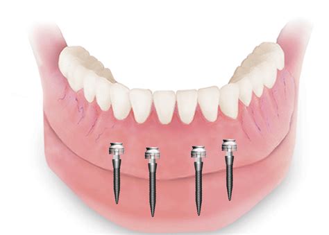Implant Supported Dentures Madison Avenue Smiles