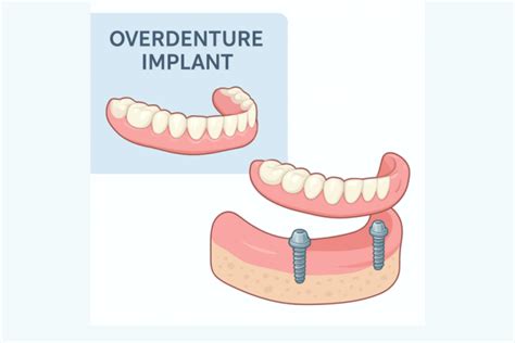 Everything You Need To Know About Overdentures Aligner32