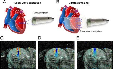 Real Time Assessment Of Myocardial Contractility Using Shear Wave Imaging Journal Of The