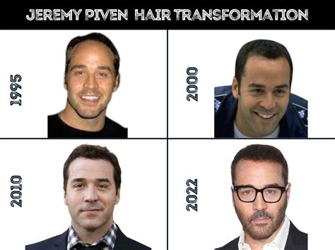 Jeremy Piven Hair Transplant Hair Loss And Technical Analysis