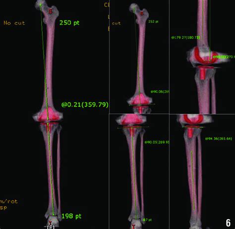 After Implantation Of The Prostheses Limb And Prosthesis Alignments