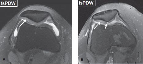 Cartilage Musculoskeletal Key