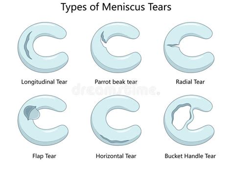 Meniscus Tear Types Diagram Medical Science Stock Vector Illustration