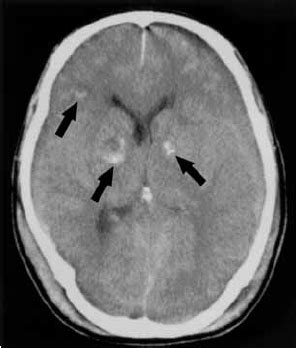 Diffuse Axonal Injury