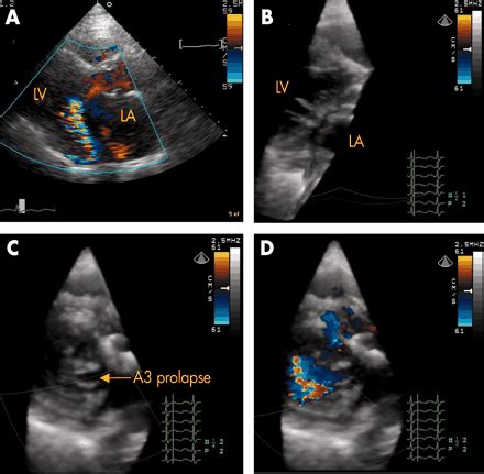 Mitral Valve Anterior Leaflet Prolapse By Real Time Three Dimensional Transthoracic