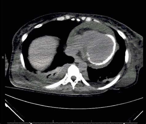 Figure 1 From A Case Of Left Ventricular Myocardial Calcification In A Patient With Severe
