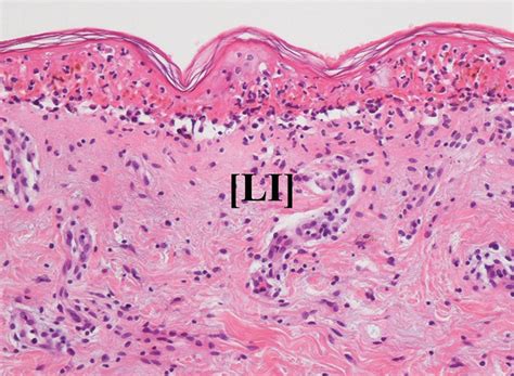 A Case Of Microstomia Subsequent To Toxic Epidermal Necrolysis