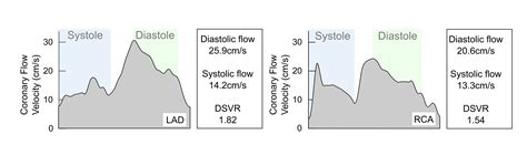 Phasic Flow Patterns Of Right Versus Left Coronary Arteries In Patients