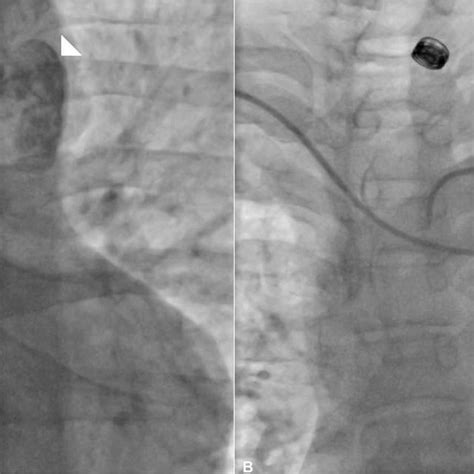 A B Contrast Injection Through Diagnostic Catheter Showing Download Scientific Diagram