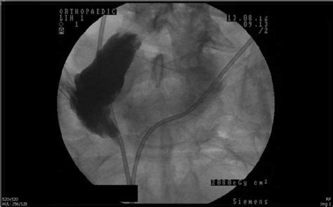 Loopogram Revealed The Stricture At 4 Cm Proximal To The Skin Opening Download Scientific