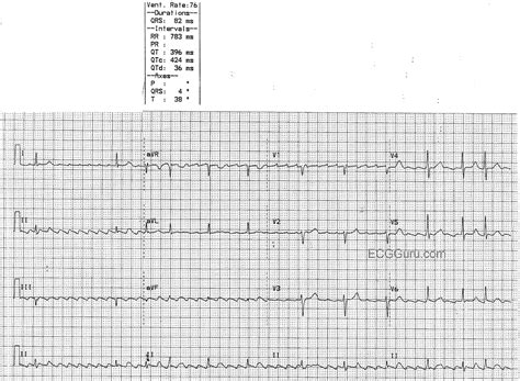 Atrial Flutter With Variable Conduction Ecg Guru Instructor Resources