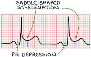 St Elevation And Pr Depression