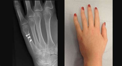 Hand Fractures Cosmetic Enclave