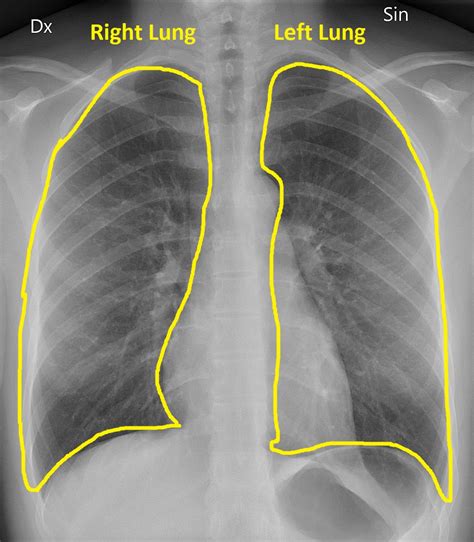 Radiology Normal Chest X Rays Glass Box Medicine
