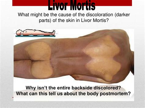 Human Livor Mortis