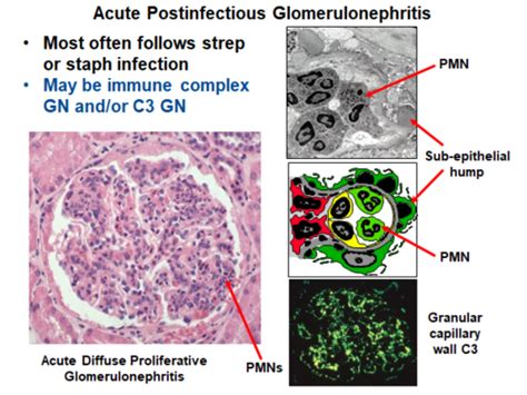 Diffuse Proliferative Glomerulonephritis Em